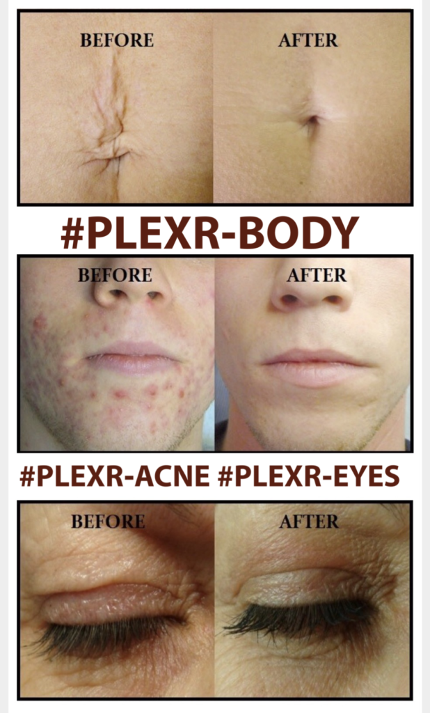 Plexr Plasma - Renew